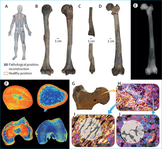 The oldest case of osteopetrosis in a human skeleton: exploring the ...